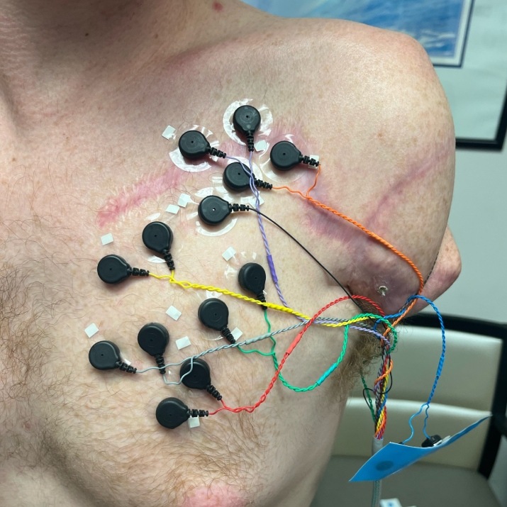 TMR Surgery: Improve Function & Reduce Amputation Pain